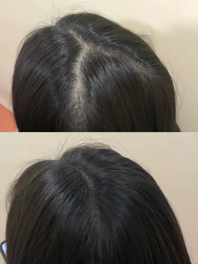 Mesotherapy Hair Before and After: Transformative Results: Dermaxshop