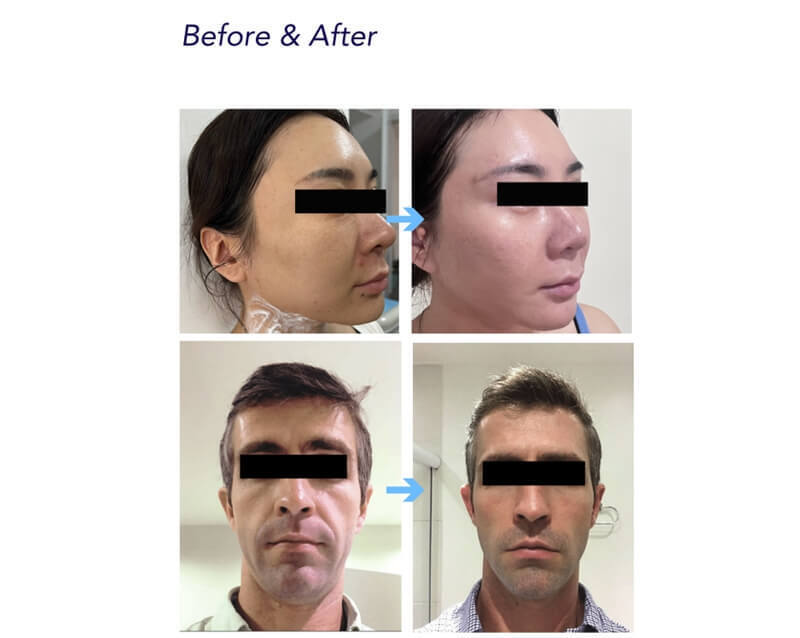 Calcium Hydroxylapatite Filler Cost: Balancing Quality and Price ...