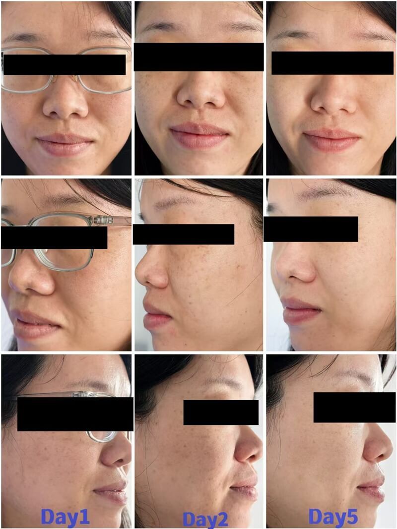 Real PNPURE Polynucleotides Treatment Before and After: Dermaxshop