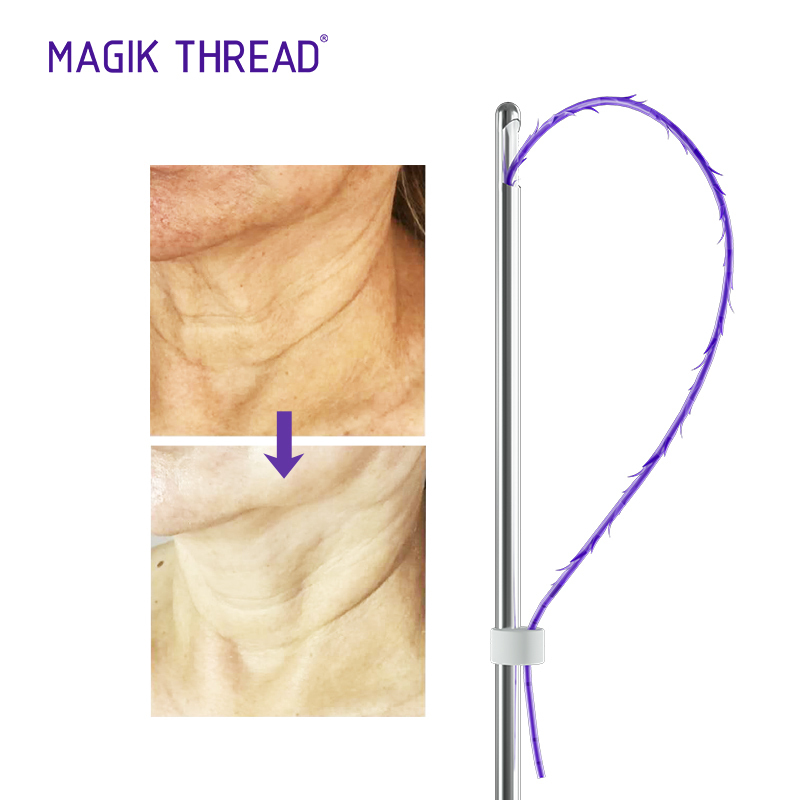 Biostimulator Injections Before and After: Botulinum, PLLA, and PDO ...